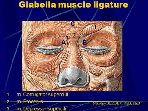 Serdev Sutures® In Upper Face Brow And Temporal Lift Glabella Muscle