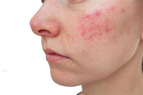 Rosacea How To Improve And Maintain Your Skins Health Skinbase