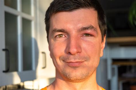 Premium Photo A Red Swollen Eyelid On A Mans Face In Closeup Is An