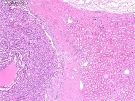 Well Differentiated Neuroendocrine Tumor