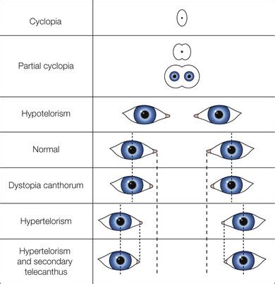 Ocular Hypertelorism Symptoms Ocular Manifestations Of Chromosomal Abnormalities Tfsghk