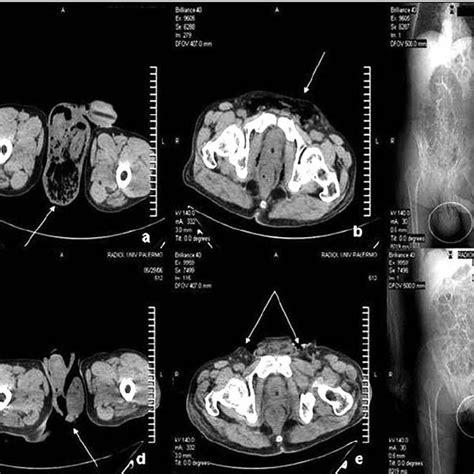 CT Scan Before A B C And After D E F Surgery Download Scientific Diagram