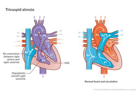 Tricuspid Atresia Life Expectancy Uajet