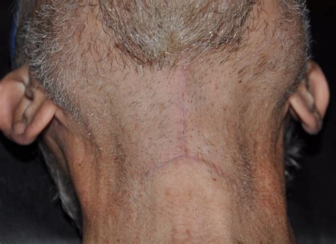 The Essential Steps In The Direct Necklift Explore Plastic Surgery