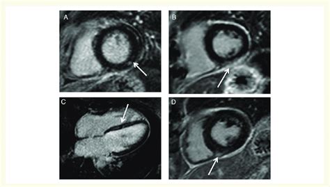 Different Infarct Atypical Patterns Of Lge In Htx Patients A Diffuse Download Scientific Different Infarct Atypical Patterns Of Lge In Htx Patients A Diffuse Download Scientific