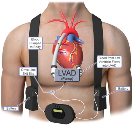 Lvad Procedure In India Cost Of Lvad Procedure In India
