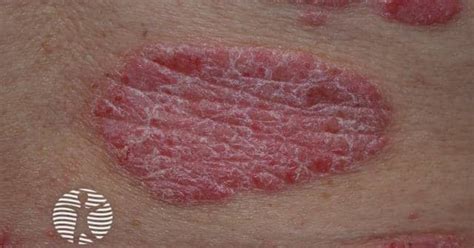 Chronic Plaque Psoriasis Image