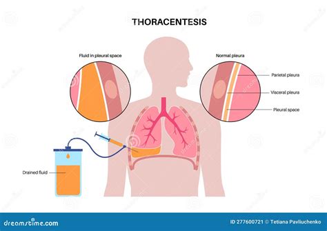 Thoracentesis Medical Procedure Cartoon Vector