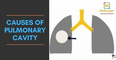 The Potential Spaces Mapping The Peritoneal Cavity Com Radiogyan