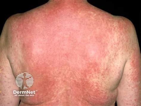 Macular Rash Derm Dx A Diffuse Erythematous Rash That Blanches With