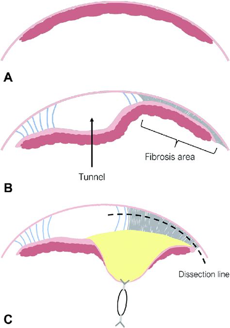 Schema Of Endoscopic Submucosal Tunnel Dissection With Ringthread