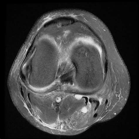 Gastrocnemius Function Location Origin And Insertion