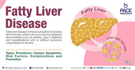 Liver Cirrhosis Symptoms Causes Stages Diagnosis And Treatment Jaran