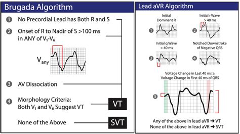 Vtとsvtの鑑別とは？ 心電図com