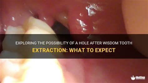 Exploring The Possibility Of A Hole After Wisdom Tooth Extraction What To Expect Medshun