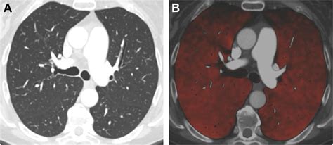 Imaging Of Solid Pulmonary Nodules Clinics In Chest Medicine
