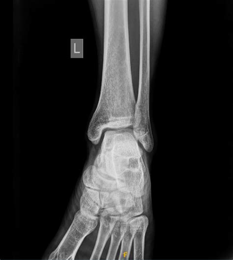 X Ray Ankle Ap