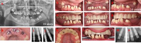 Successful Complete Oral Rehabilitation Of A Patient With Osteopetrosis