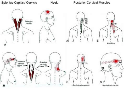 Trigger Point 3a Ppt