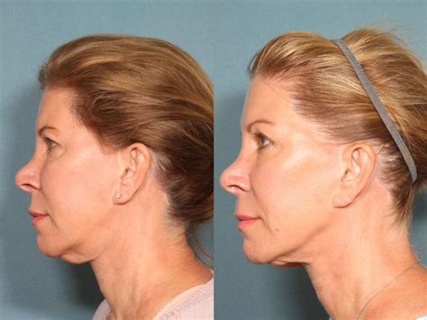 Non Surgical Facelift In Parker Co Aesthetics 360