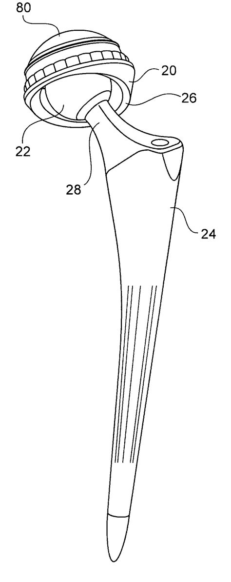 Acetabular Liner Patented Technology Retrieval Search Results Eureka Patsnap