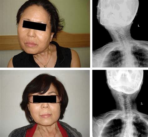 How To Treat Torticollis In Adults