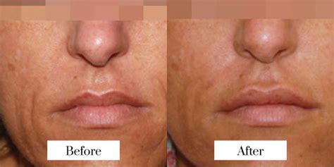 Rf Microneedling Brisbane Jade Cosmetic Clinic