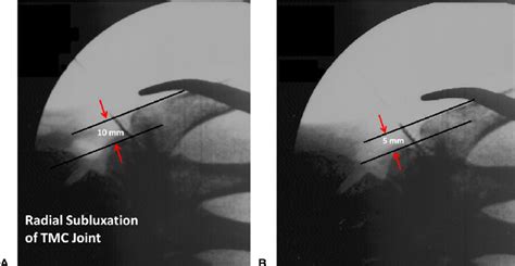 A Typical Anteroposterior Radiograph Showing Subluxation Of The Download Scientific Diagram