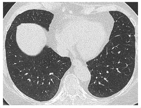 Typical Ct Features Of Intrapulmonary Lymph Node In The Left Lower Download Scientific Diagram