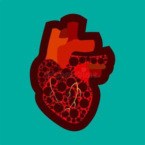 Congenital Heart Disease Tetralogy Of Fallot Stock Vector