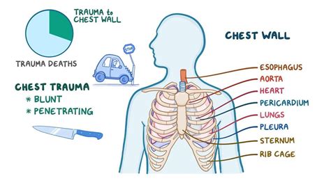 Flail Chest Diagram