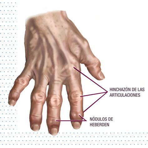 Artrosis Y Artritis En Las Manos Diferencias Y Tratamientos Qxjzvs