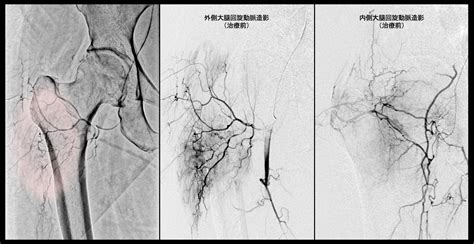 介護負担により生じた5年前からの右下肢の激痛（大転子滑液包炎） なごやevtクリニック
