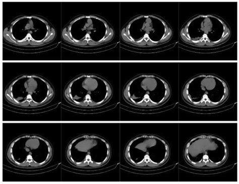 Ct Scan Images Showed That The Pyothorax Was Significantly Improved On Download Scientific