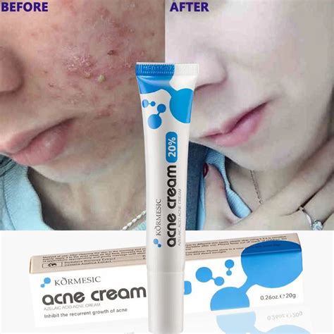 Azelaic Acid Cream 20 Acne Plus Triple Action Spot Care Balm Anti Scar