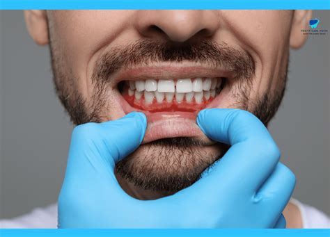 How To Treat Burned Gums From Teeth Whitening Remedies