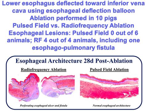 Pulsed Field Ablation Versus Radiofrequency Ablation Circulation Arrhythmia And Electrophysiology