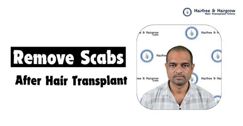 How To Safely Remove Scabs After Hair Transplant