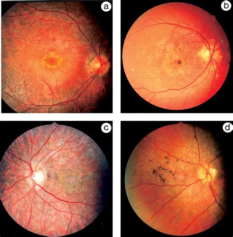 Cone Dystrophy Color Blindness At Zac Wilmot Blog