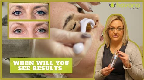 How Often Can You Dermaroll Your Face Achieve Even Skin Tones Youtube