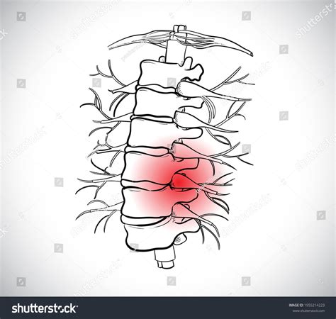 탈지된 디스크 이미지는 심각한 허리 통증을 스톡 일러스트 1955214223 Shutterstock