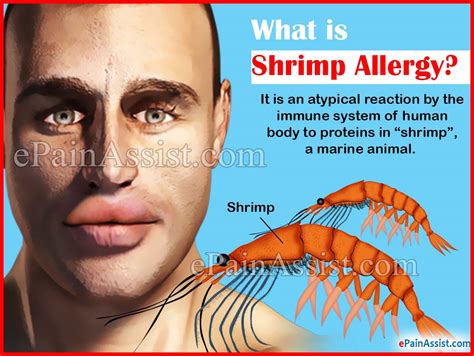 What Is Shrimp Allergy Know Its Causes Signs Symptoms And Diagnosis