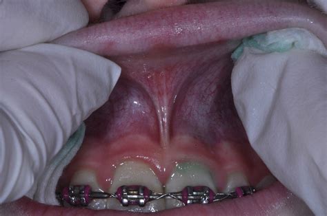 Labial Frenectomy