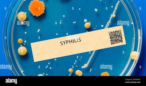 Syphilis Sexually Transmitted Bacterial Infection That Can Cause