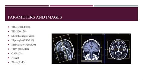 Mri Epilepsy Protocol Pptx