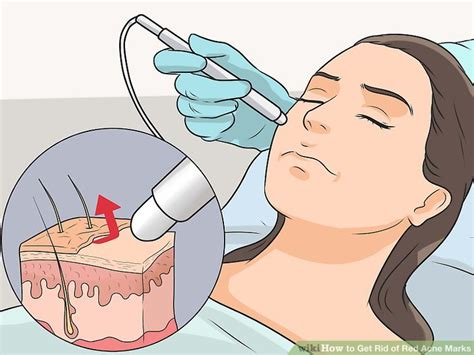 Ways To Get Rid Of Red Acne Marks WikiHow