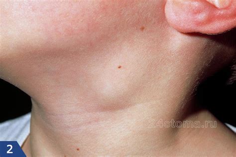 Как выглядят воспаленные лимфоузлы на шее фото