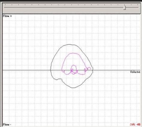Sleep Apnea Its All About Airflow The Sleep And Respiratory Scholar