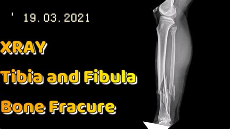 Tibia And Fibula X Ray