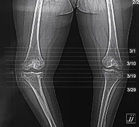 Msk Abnormal Ante Version And Varus Deformity Of Knee Joint 2